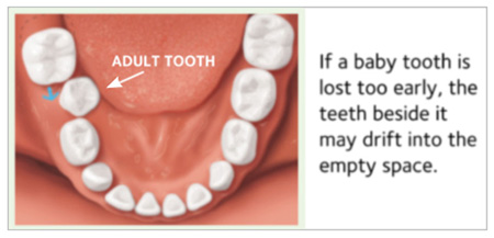 Tooth Decay In Baby Teeth | Pannu Dental Group