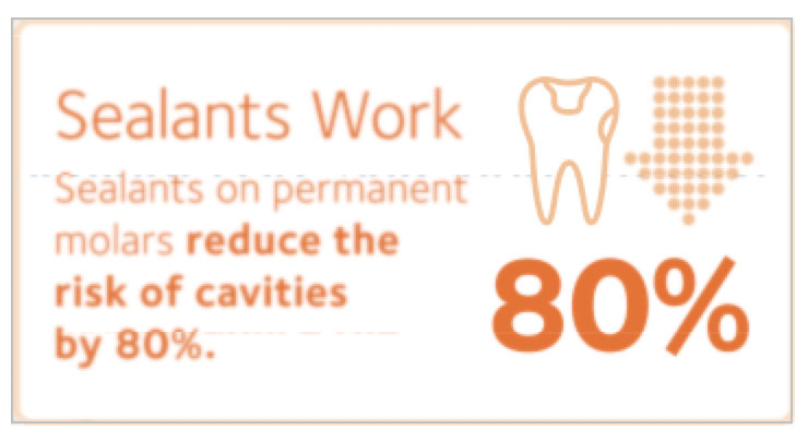 Dental Sealants Protecting Teeth, Preventing Decay | Pannu Dental Group