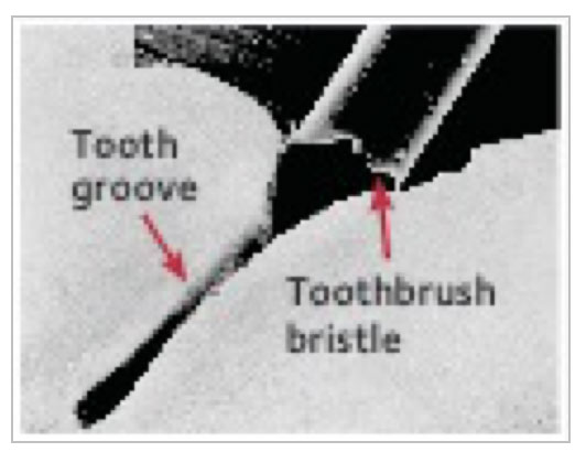 Sealant Quick Reference | Pannu Dental Group